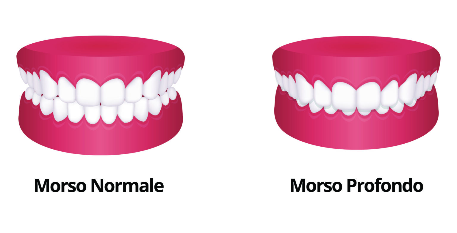 Morso Profondo: Cause, Sintomi e Rimedi - ADC Dental Center