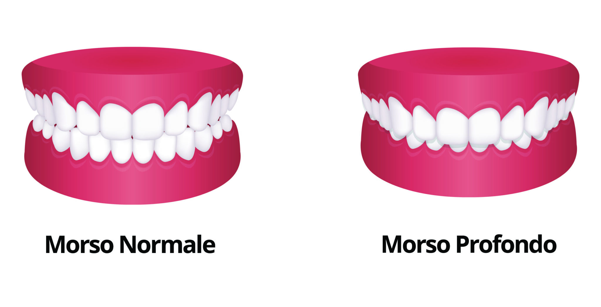 Morso Profondo: Cause, Sintomi e Rimedi - ADC Dental Center